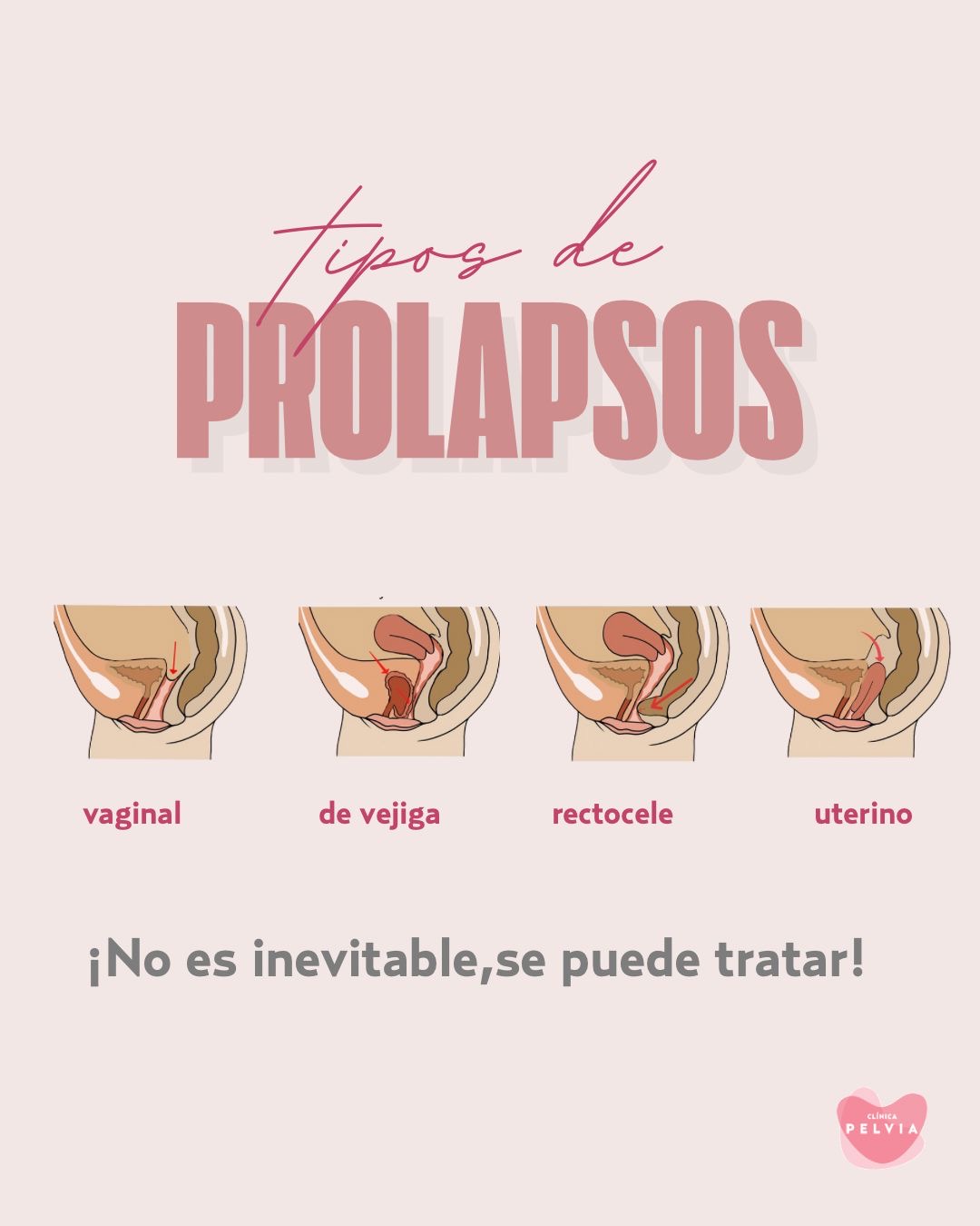 Prolapso: causas, síntomas y tratamiento con fisioterapia de suelo ...